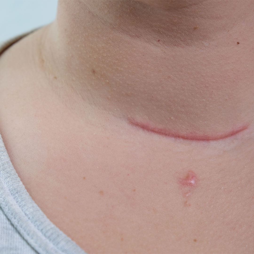 Silicone Based Scar Treatment | ScarX
